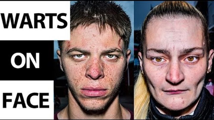 Warts On Face: 100% Safe Wart Removal